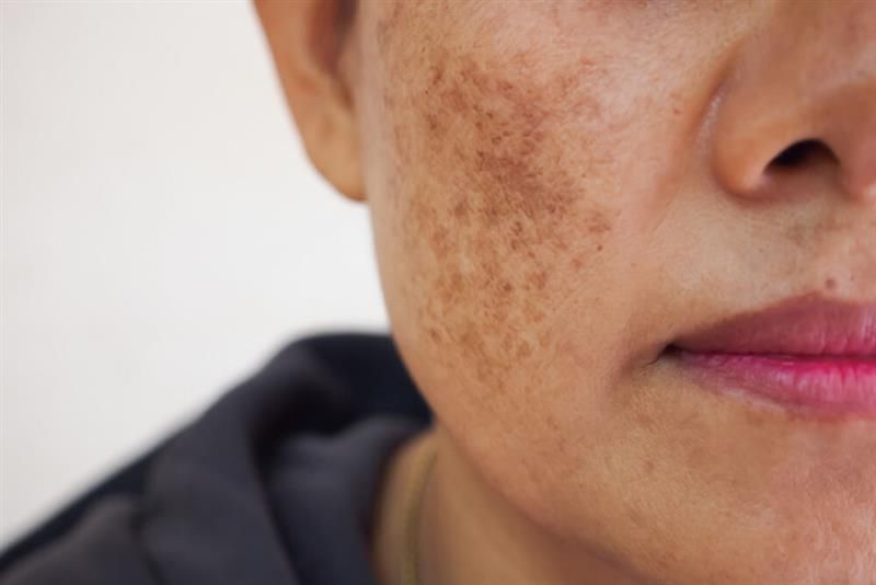 Ketahui Penyebab dan Cara Mengatasi Melasma Saat Hamil